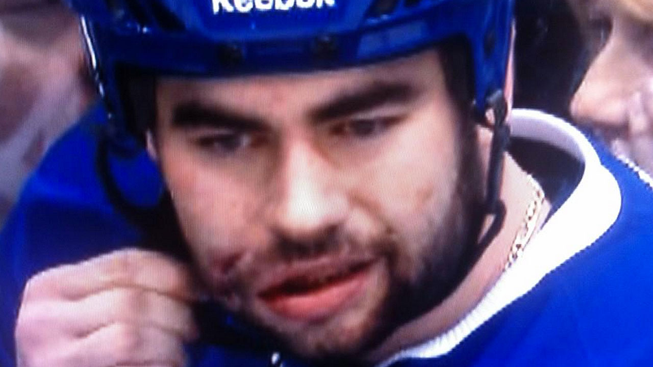 Maple Leafs’ Polak gets stitches after puck to face